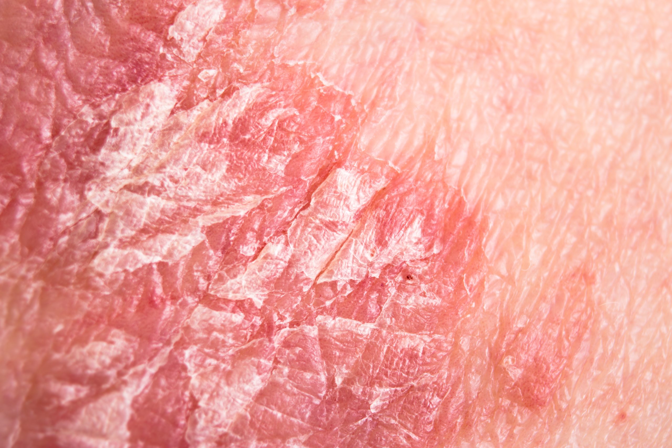 Psoriasis - Dermatology Resources for Healthcare Professionals | Wiley Knowledge Hub